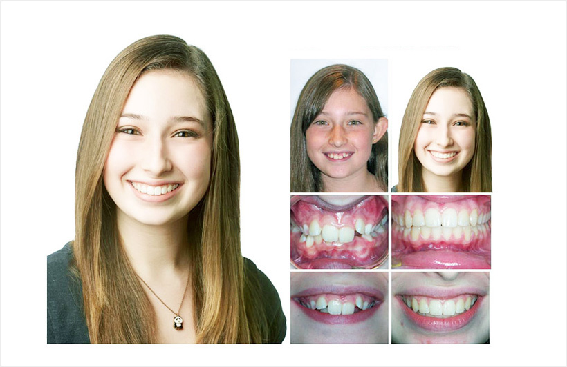 See before and after photos of our patients. Segal and Iyer Orthodontics.