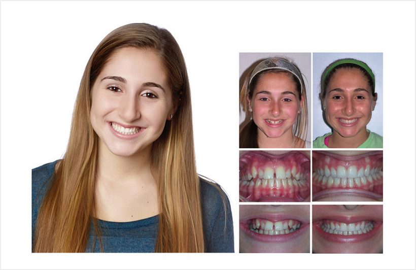 See before and after photos of our patients. Segal and Iyer Orthodontics.